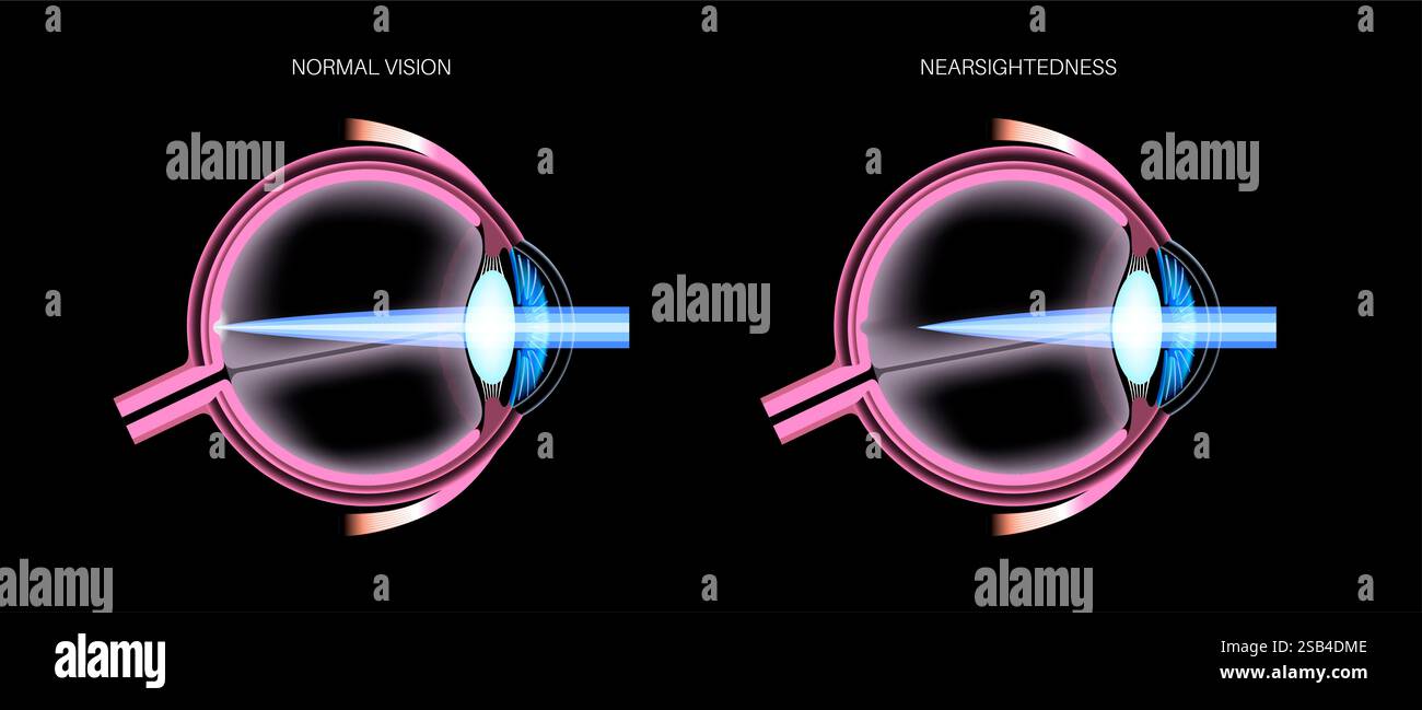 Illustration of a normal eye and an eye with nearsightedness ...