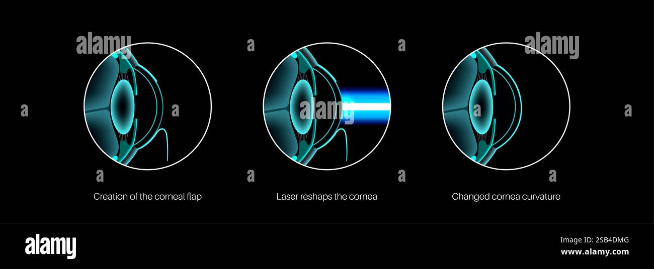 Illustration of LASIK (Laser-Assisted In Situ Keratomileusis) also ...