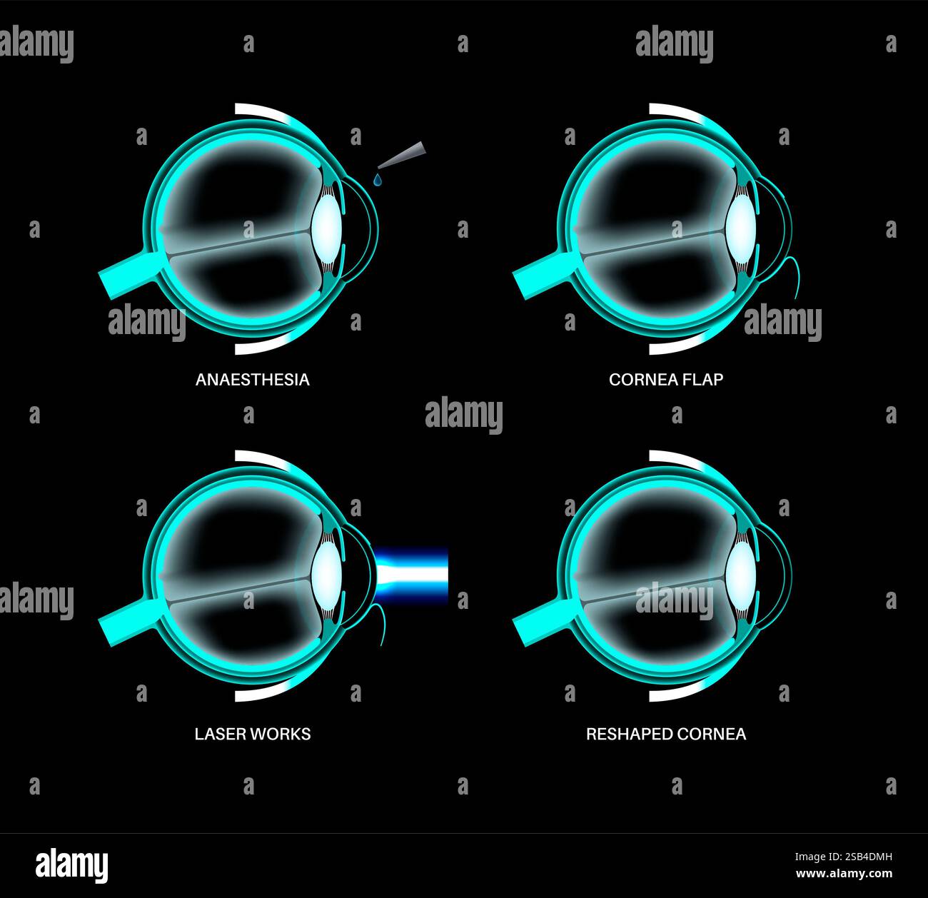 Illustration of LASIK (Laser-Assisted In Situ Keratomileusis) also known as laser eye surgery ...