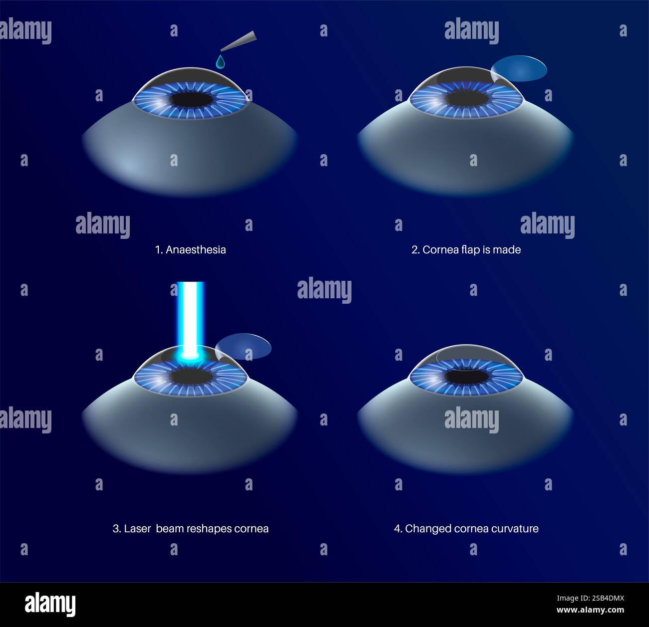Illustration of LASIK (Laser-Assisted In Situ Keratomileusis) also known as laser eye surgery ...
