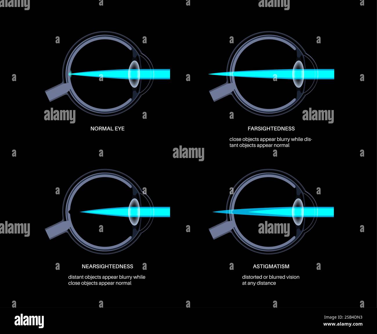 Illustration of refractive errors that impact vision. These errors occur when the shape of the ...