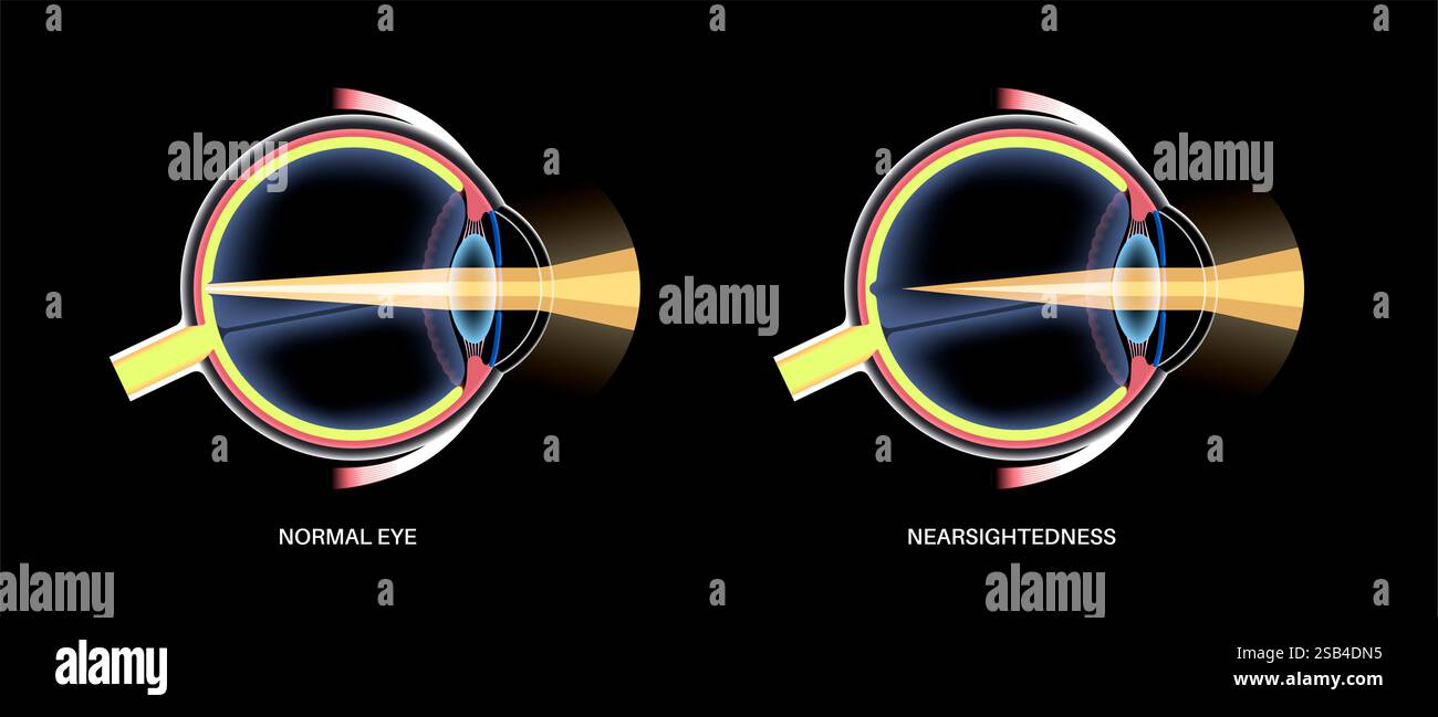 Illustration of a normal eye and an eye with nearsightedness ...