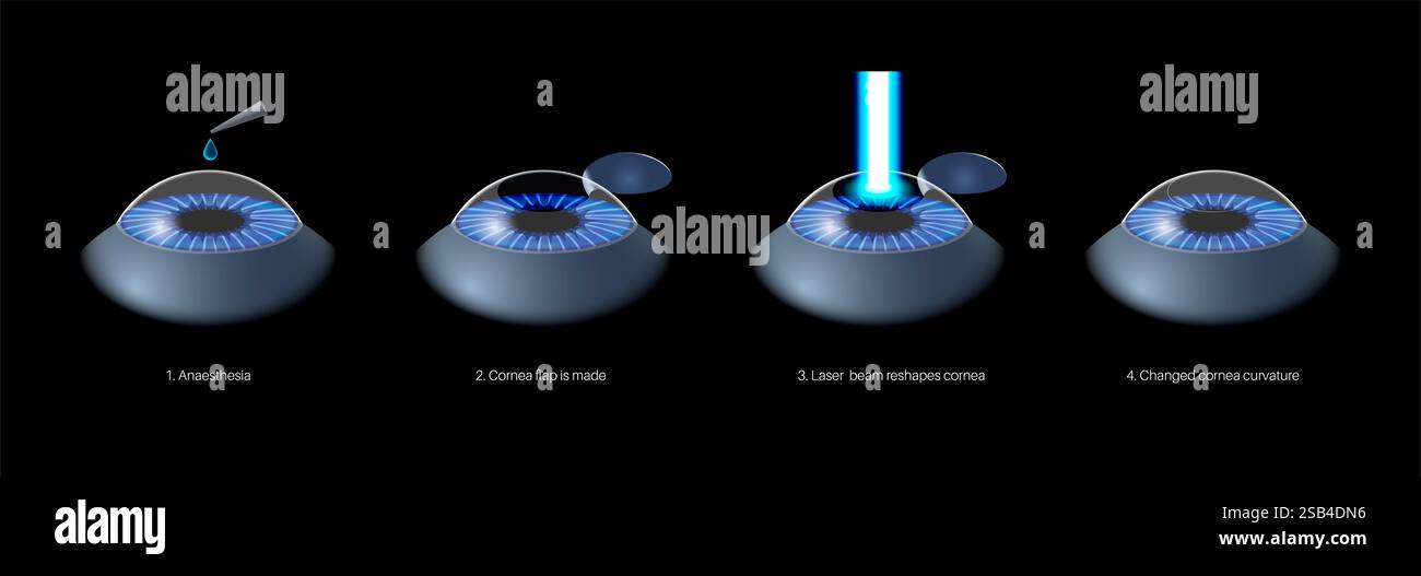 Illustration of LASIK (Laser-Assisted In Situ Keratomileusis) also ...