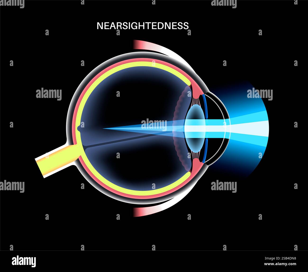 Illustration of an eye with nearsightedness. Nearsightedness is a ...