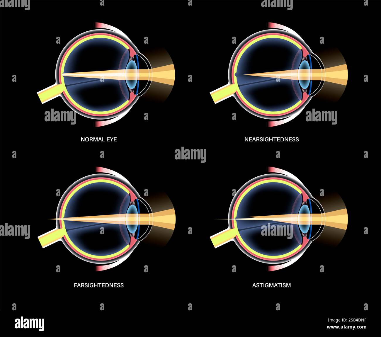 Refractive errors that impact vision hi-res stock photography and images - Alamy