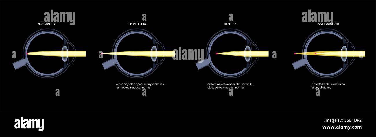 Illustration of refractive errors that impact vision. These errors ...
