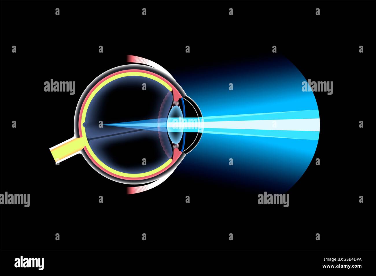 Illustration of an eye with nearsightedness. Nearsightedness is a ...