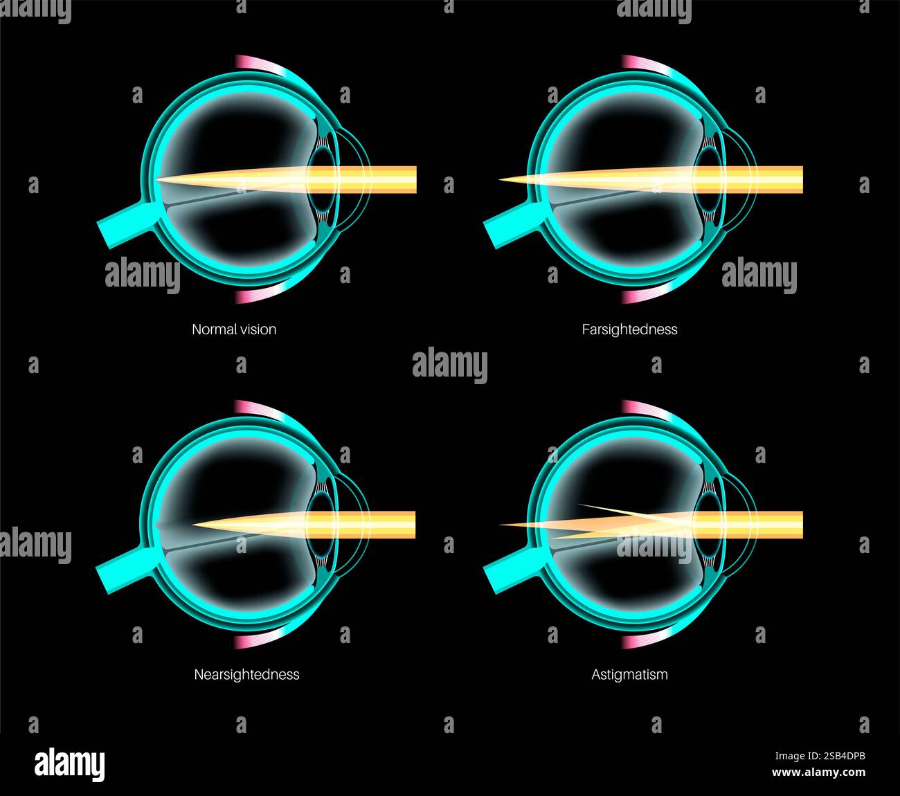 Illustration of refractive errors that impact vision. These errors occur when the shape of the ...