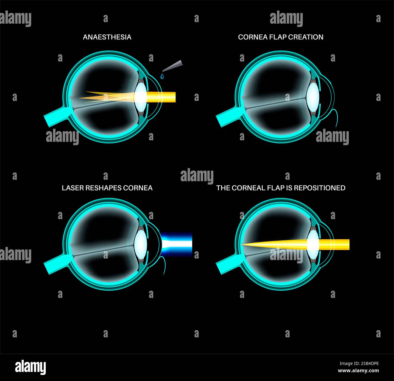 Illustration of LASIK (Laser-Assisted In Situ Keratomileusis) also ...