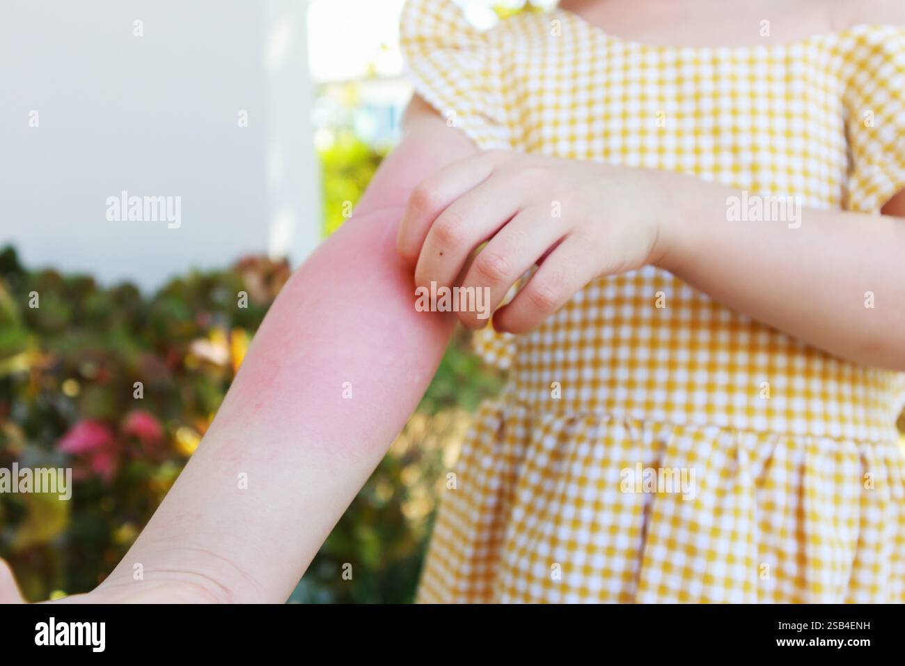 Little girl has skin rash allergy and itchy on her arm Stock Photo - Alamy
