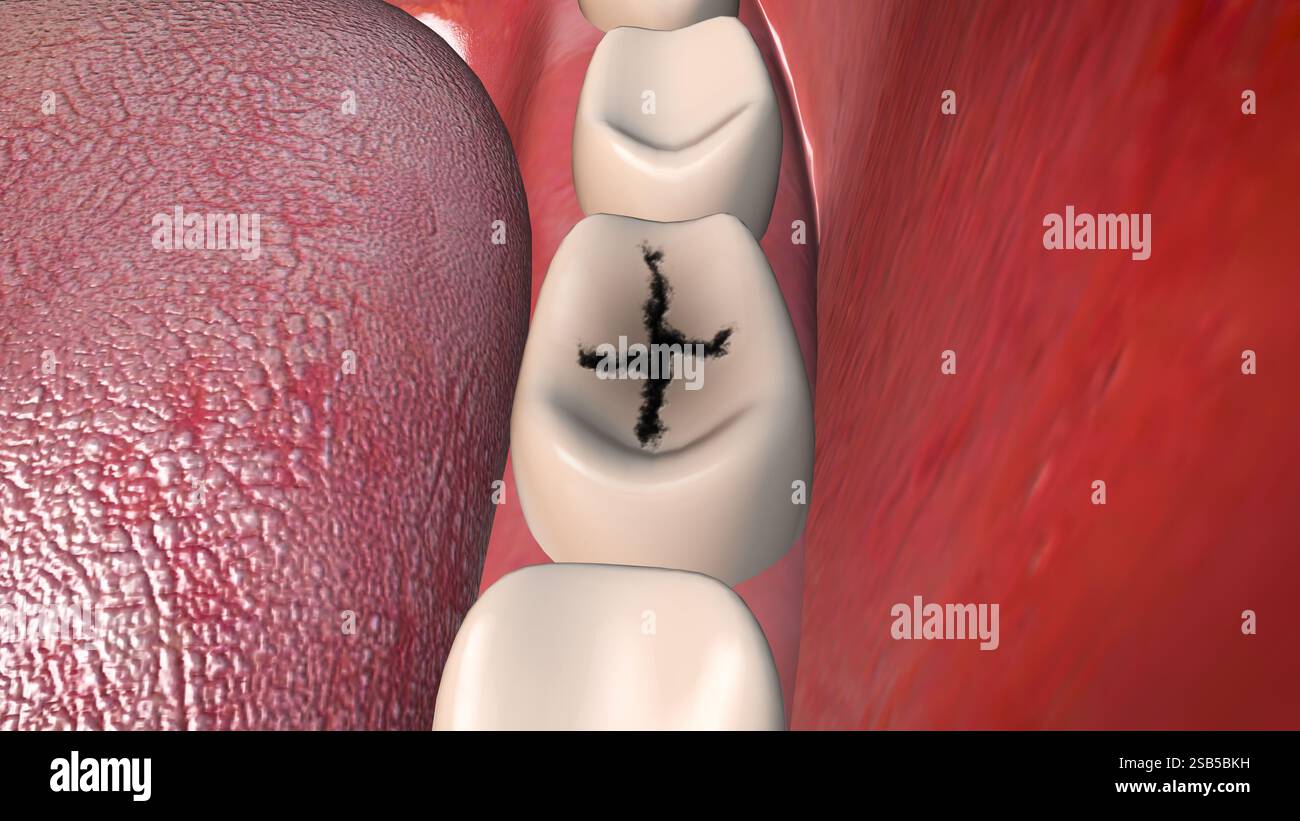 Dental Caries Formation on Molar Tooth Stock Photo - Alamy