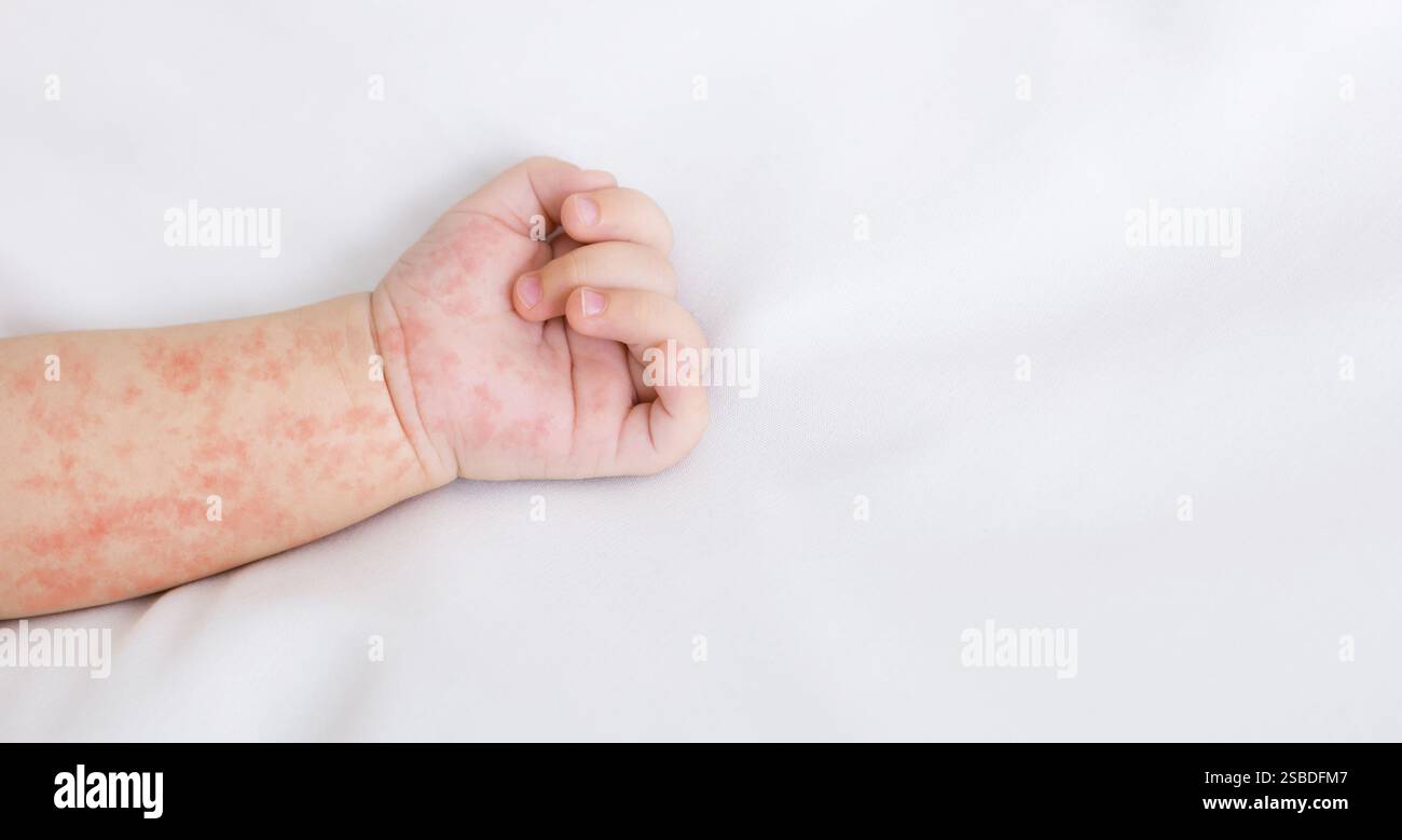 Hand of newborn baby with measles rash on white sheet Stock Photo - Alamy