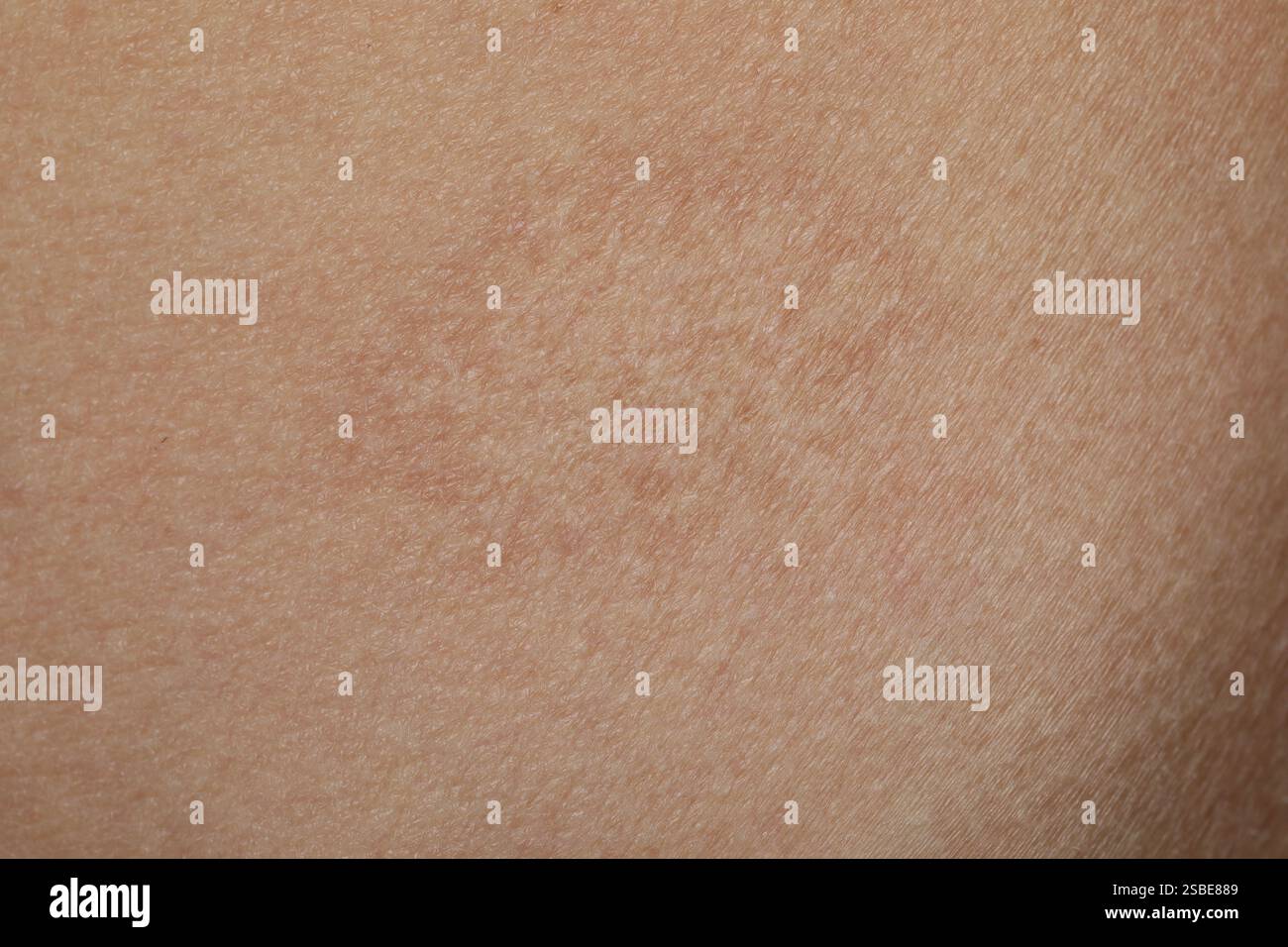 Texture of skin with scar as background, closeup Stock Photo - Alamy