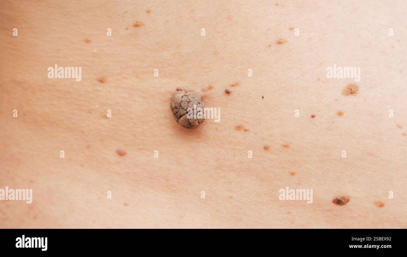 Moles and birthmarks on human skin close-up Stock Photo - Alamy