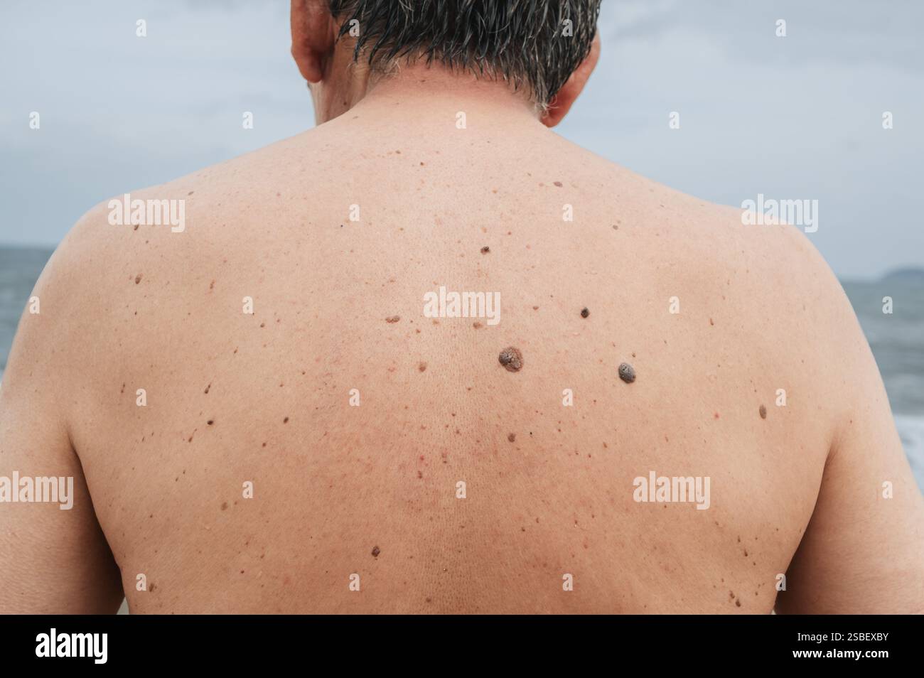 The back of an elderly man with freckles, aging spots, black, brown ...