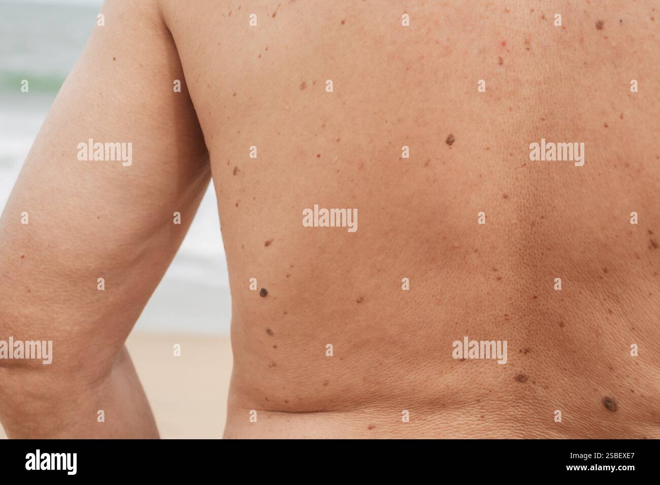 The back of an elderly man with freckles, aging spots, black, brown ...