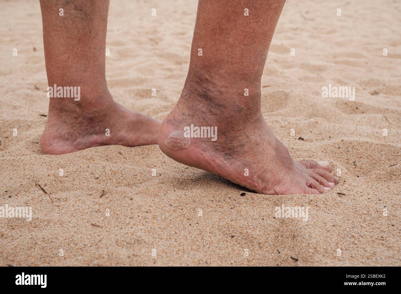 Corns, calluses on the heels of an elderly man's feet, inflamed dilated ...