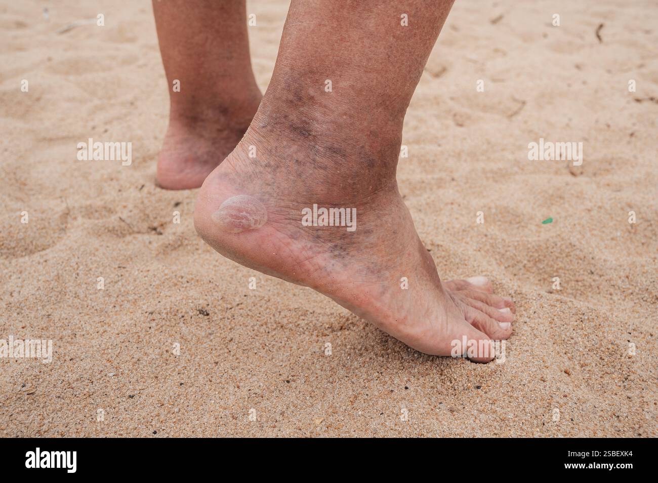 Corns, calluses on the heels of an elderly man's feet, inflamed dilated ...