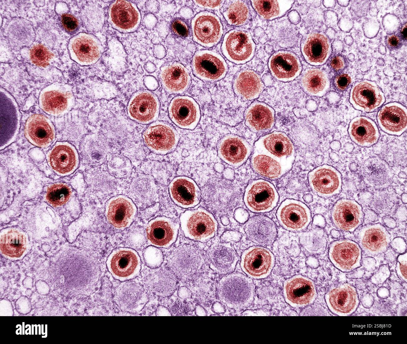 Transmission electron micrograph of cytomegalovirus (CMV) particles ...