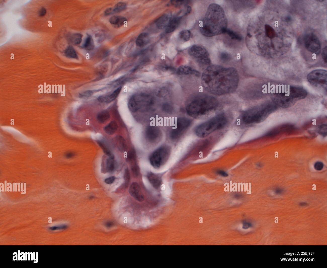 When cancer cells metastasize to the bone microenvironment from the ...