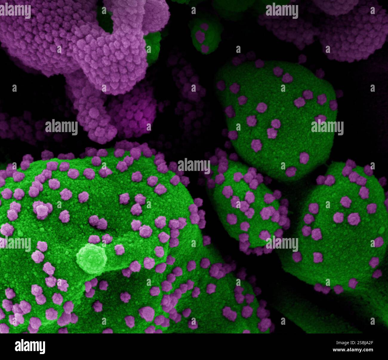 Colorized scanning electron micrograph of an apoptotic cell (green ...