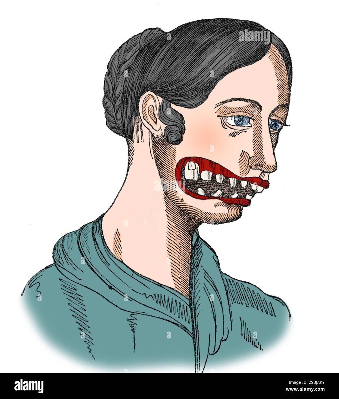 Phossy jaw, formally known as phosphorus necrosis of the jaw, was an ...