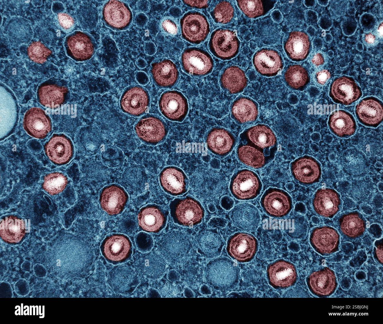 Transmission electron micrograph of cytomegalovirus (CMV) particles ...
