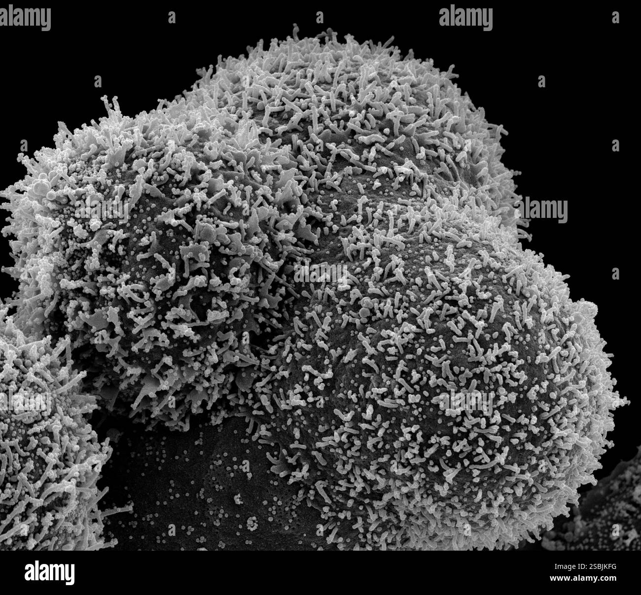 A cluster of CCL-81 cells infected with SARS-CoV-2 virus particles ...