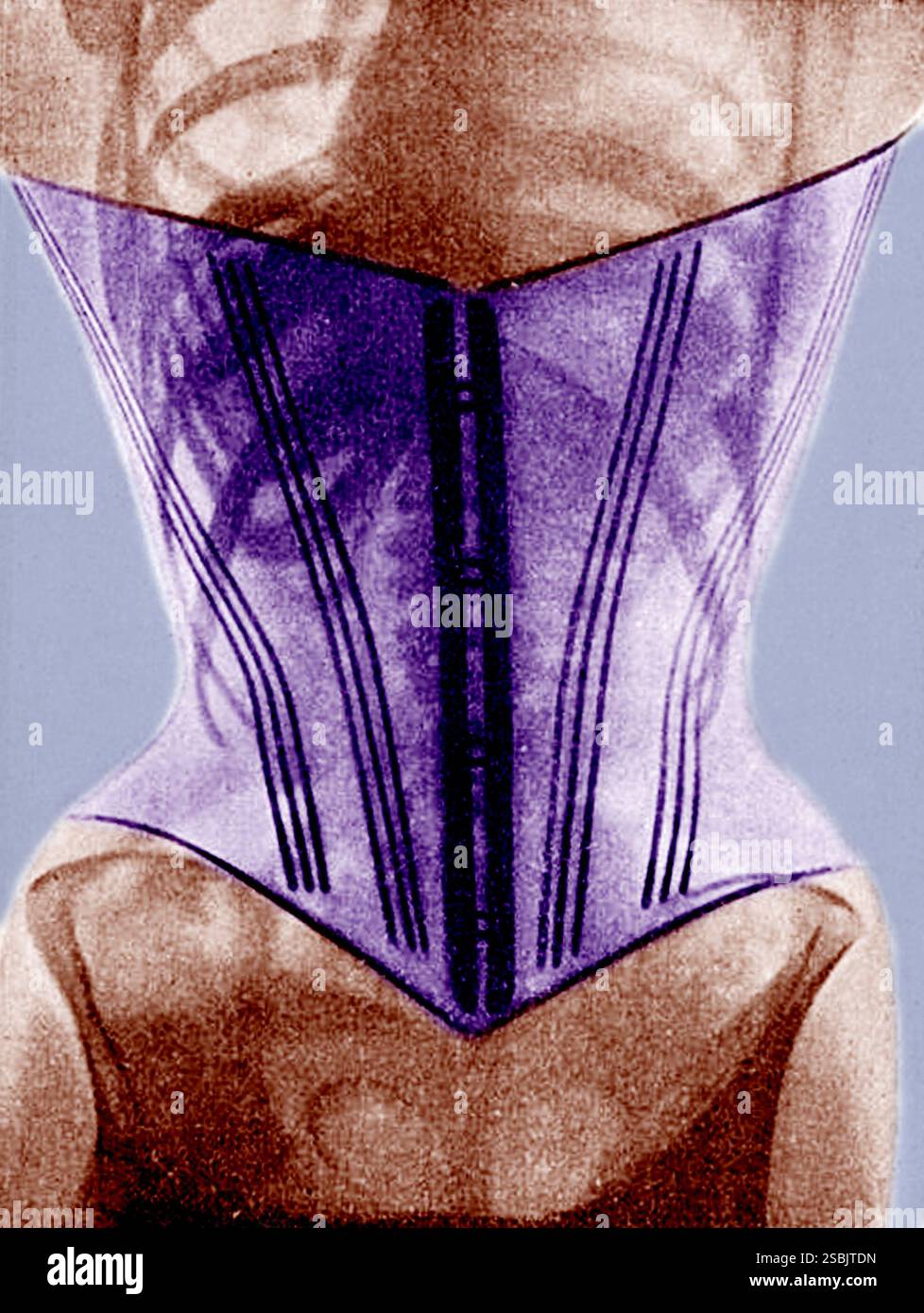 X-ray image (frontal view) of a woman wearing a corset from French ...