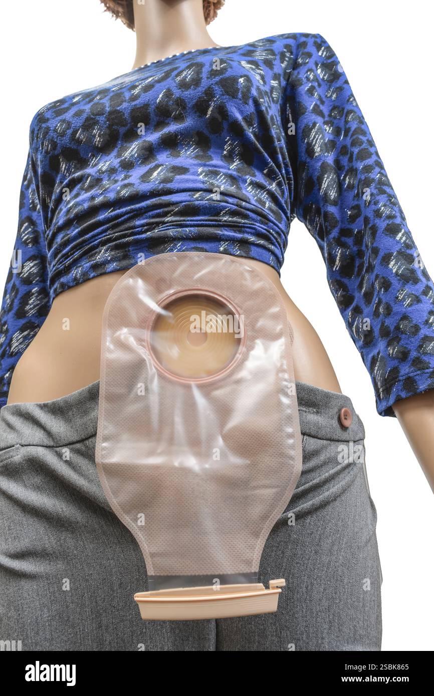 Vertical shot of a female mannequin wearing a two-part colostomy bag ...