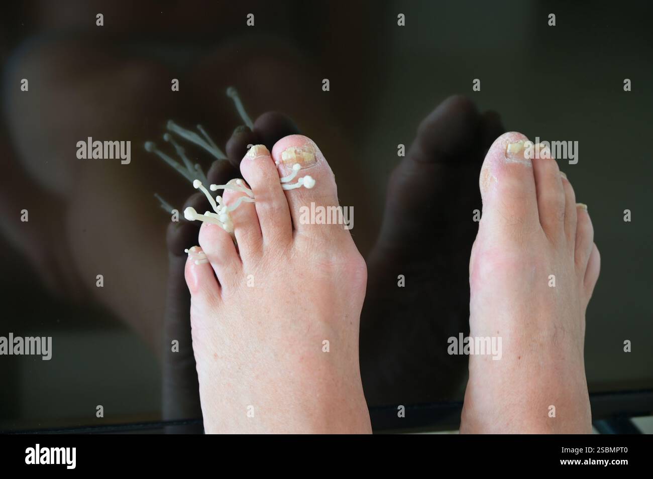 Men feet with toe nail fungus and mushrooms on dark Stock Photo - Alamy
