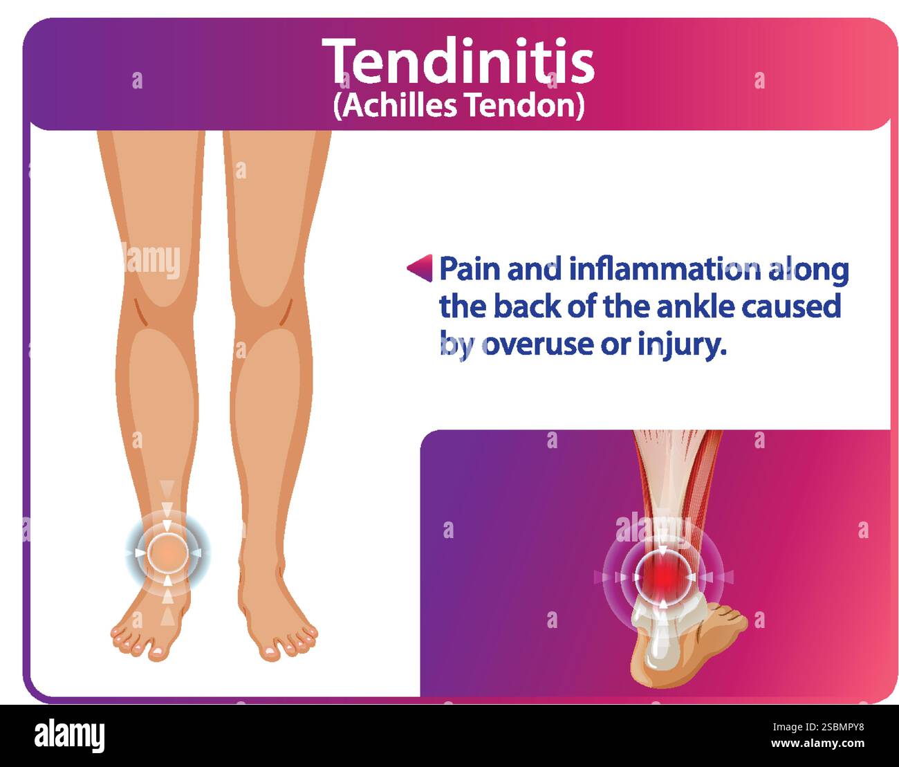 Illustration of Achilles tendon pain and inflammation Stock Vector ...