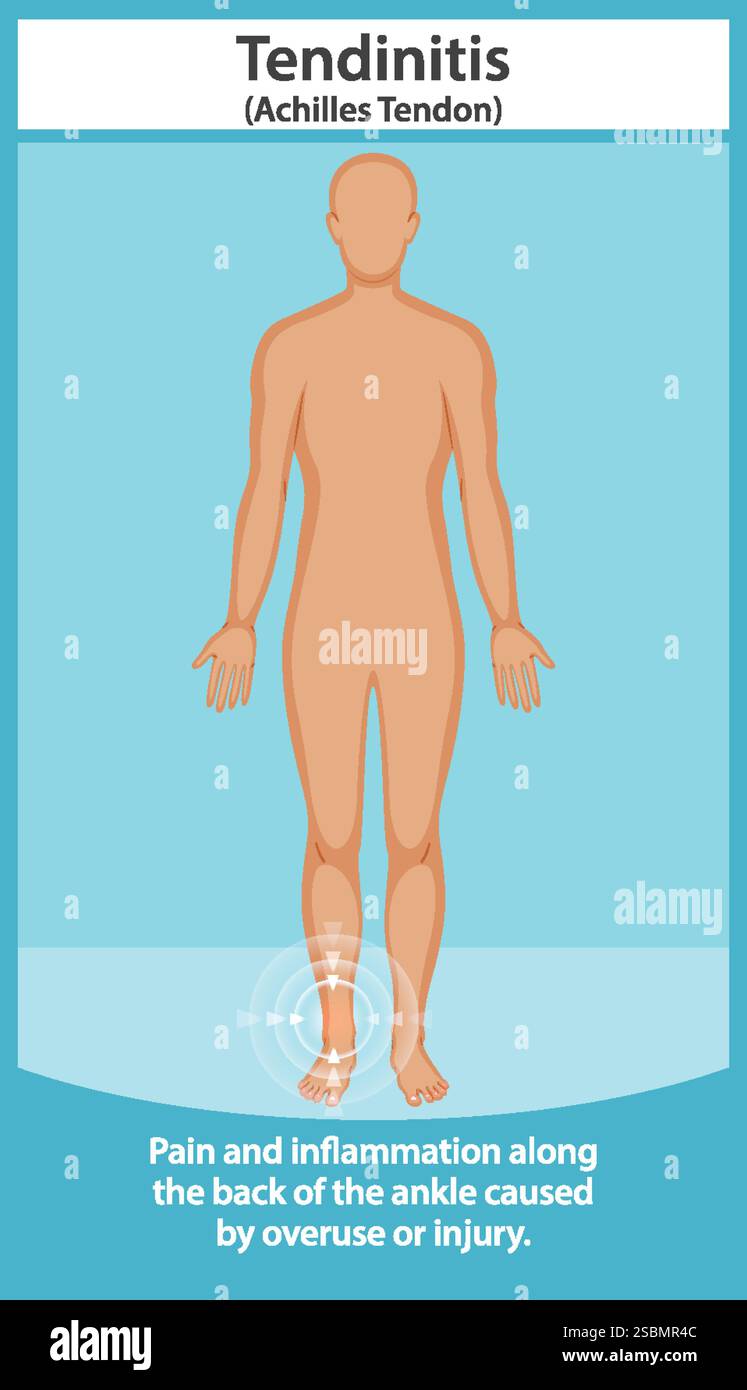 Achilles tendon anatomy vector vectors hi-res stock photography and ...