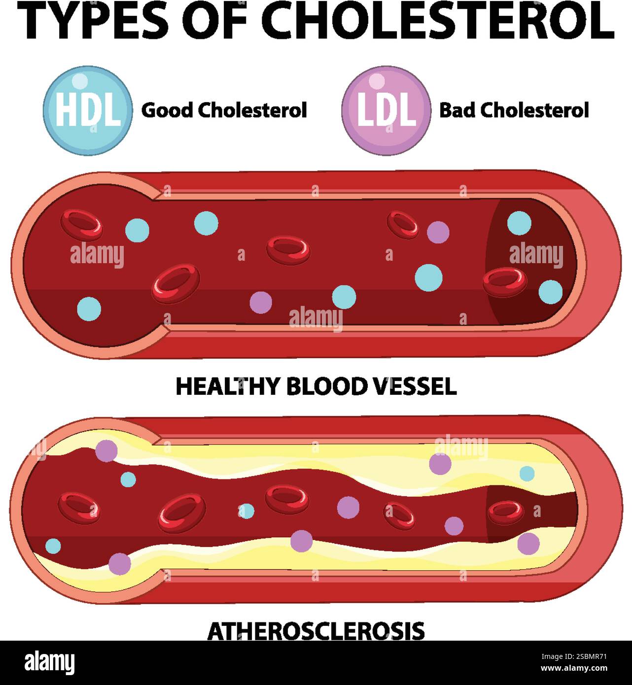 Illustration of cholesterol types and blood vessel health Stock Vector ...