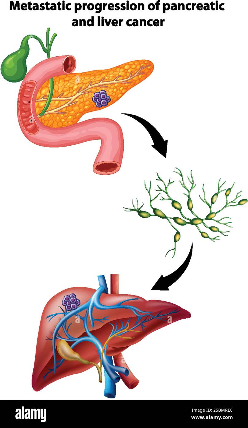 Pancreatic cancer medical vector Stock Vector Images - Alamy