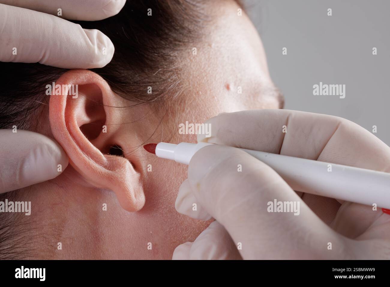 The doctor surgeon is preparing for the operation Otoplasty, Ear ...