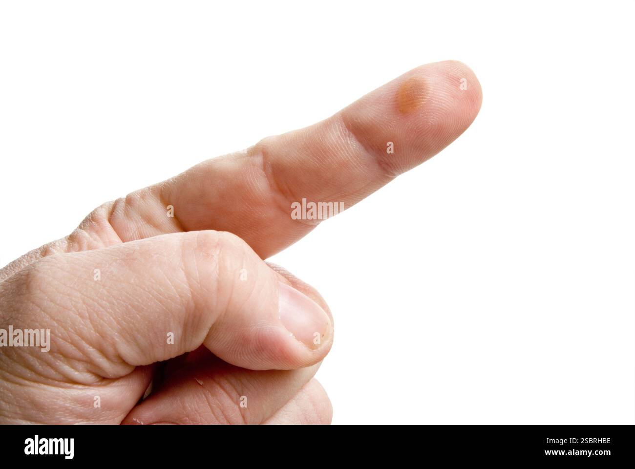 A burn blister on an index finger Stock Photo - Alamy