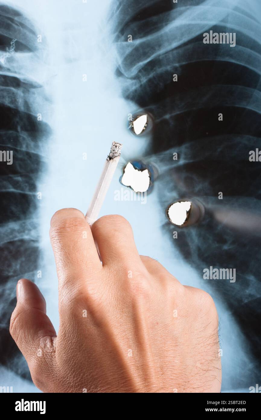 X-ray lung with a hand holding a cigarette Stock Photo - Alamy