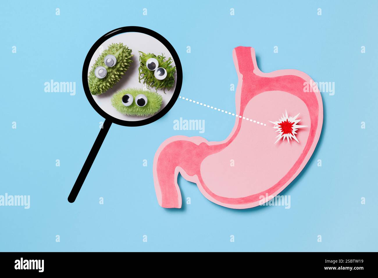 A paper cutout of a stomach with an inflamed area and causing of it ...