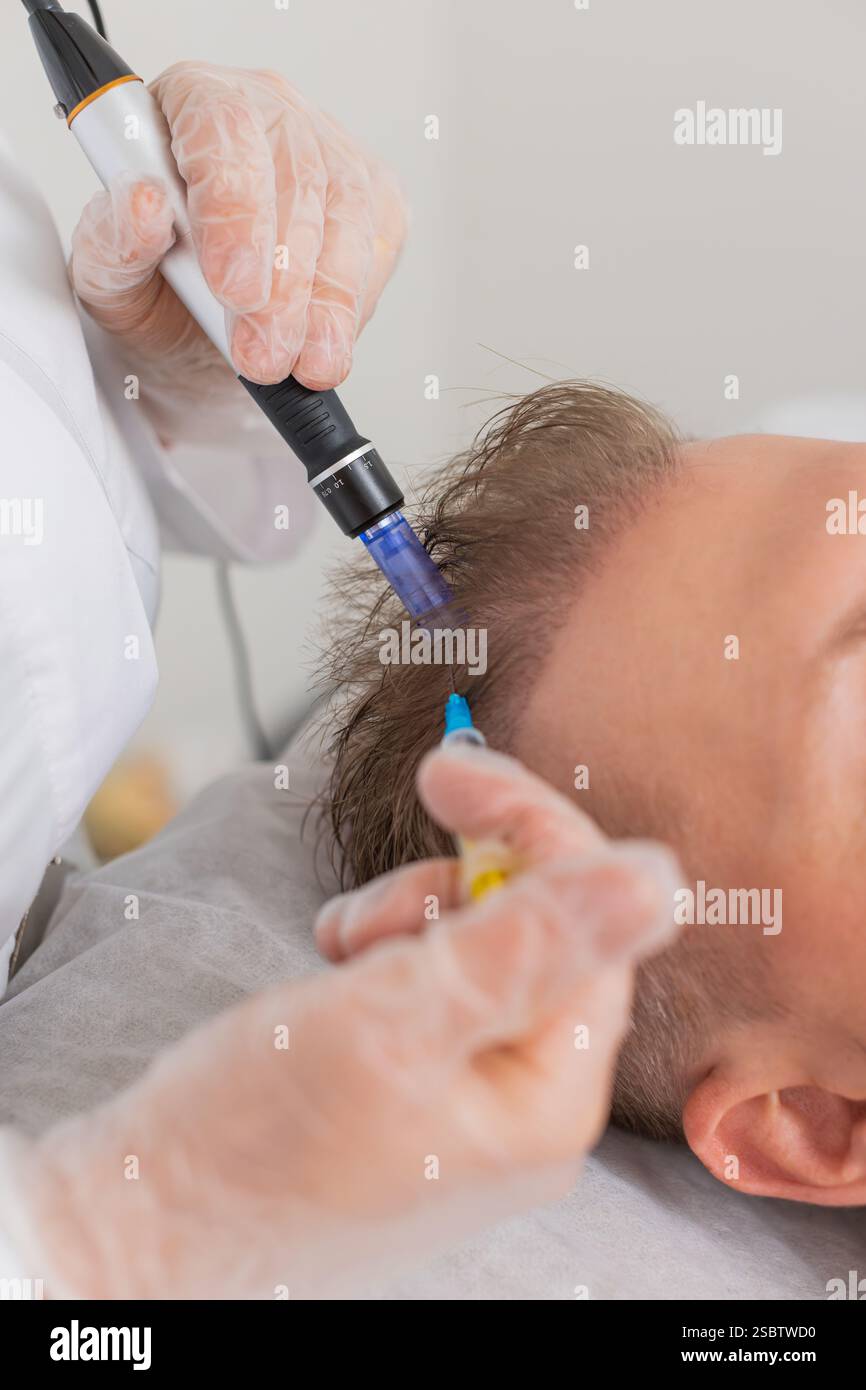 Alopecia. Man hair loss improve growth treatment regeneration, dermapen ...