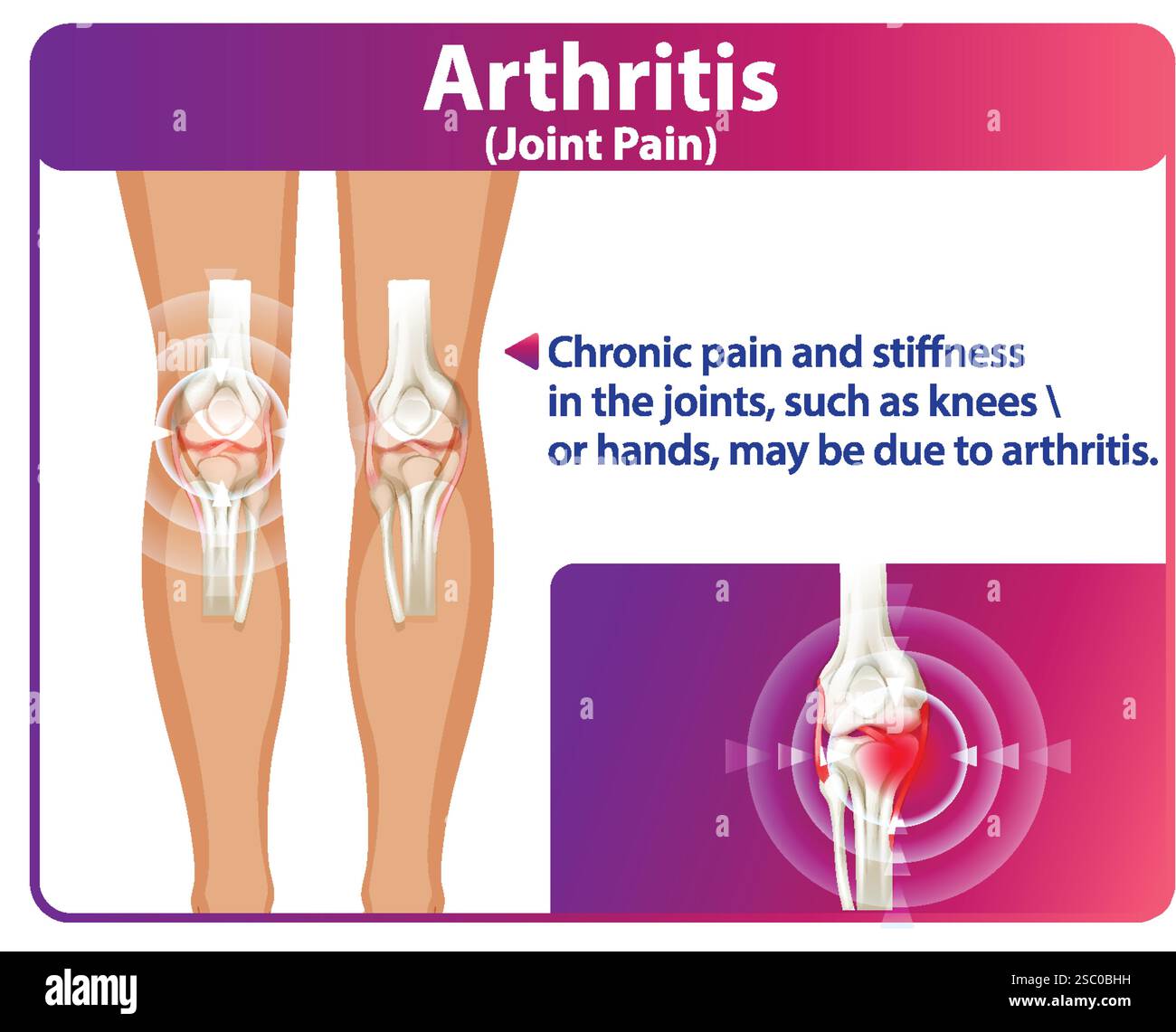 Illustration of arthritis affecting knee joints Stock Vector Image ...