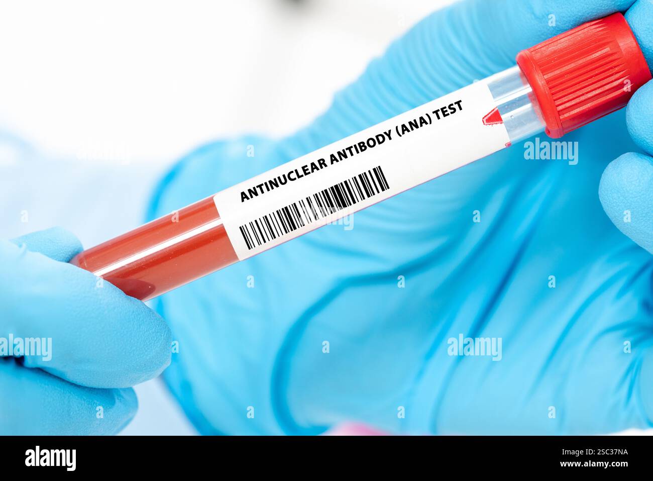 Antinuclear Antibody (ANA) Test Detects antibodies that target the body ...