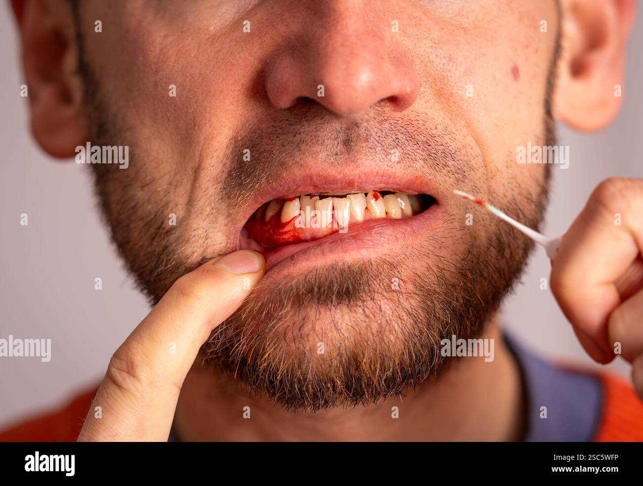 Man Holding Dental Rubber Toothpick Showing Bleeding Gums, Gum Disease ...