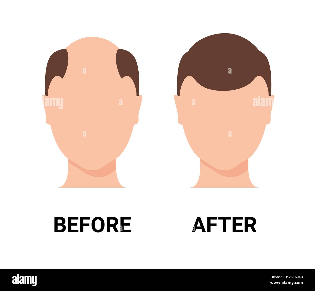 Hair loss man icon cartoon vector logo. Hair loss male scalp bald illustration Stock Vector ...
