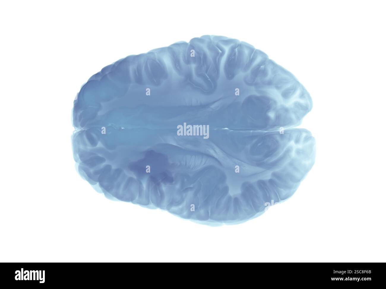 Brain MRI scan showing acute ischemic stroke, identified by a dark spot ...