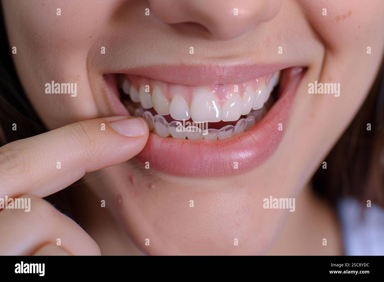 A woman is smiling and holding a clear plastic retainer in her mouth ...
