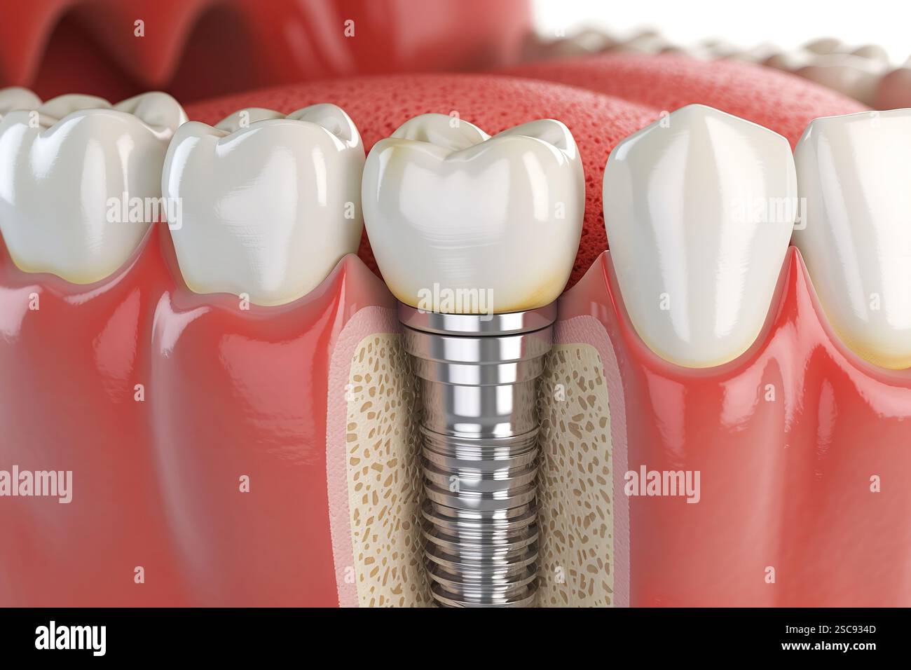 A close up of a mouth with a missing tooth and a dental implant ...