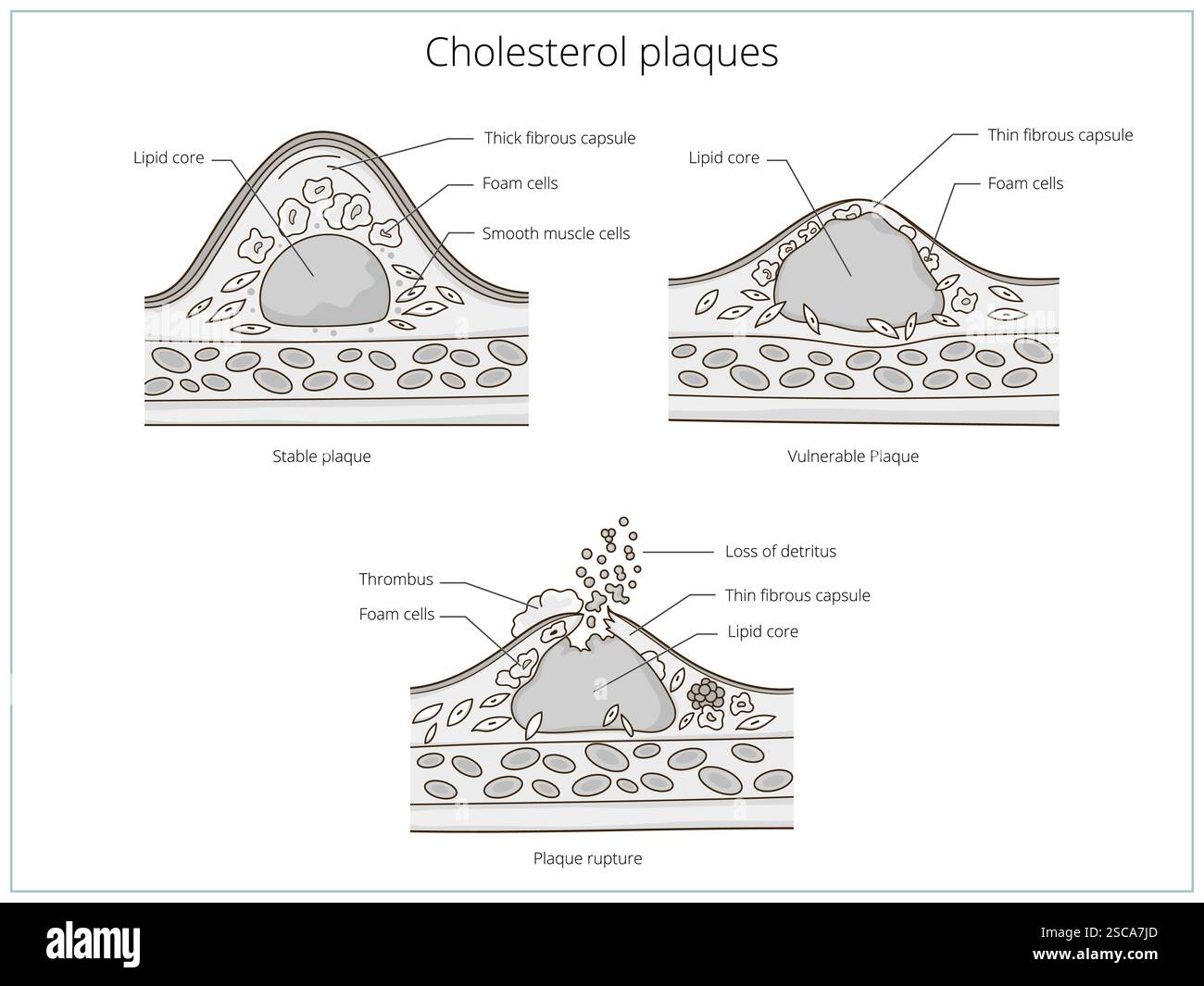 Cholesterol plaque medical educational vector Stock Vector Image & Art ...