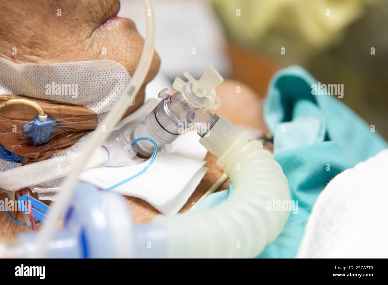 Patient asian elder women 80s flu covid19 do tracheostomy use ...