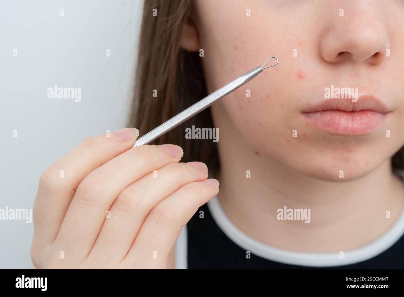 Young woman holding pimple removal tool near face showing pimple on a ...